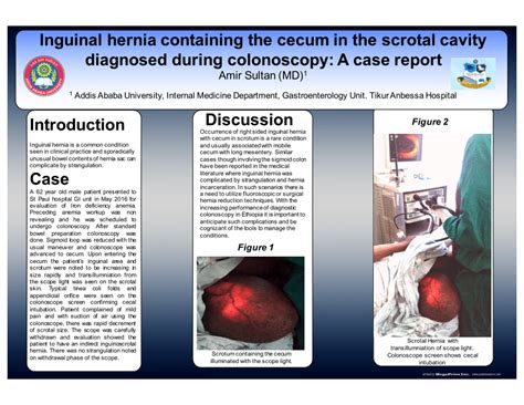 Pdf Inguinal Hernia Containing The Cecum In The Scrotal Cavity