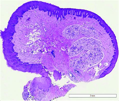 Photomicrography Of The Excisional Specimen Low Power View Of The