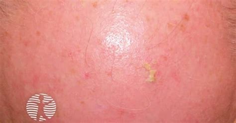 Actinic Keratoses Affecting The Scalp Image