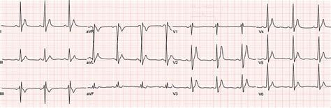 Qt Interval Ecg Book