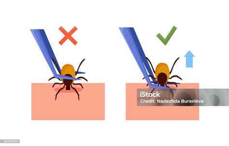 물린 후 뇌염 진드기 제거 진드기를 제거하는 방법 기생충 운반 질병 진드기가 피부에 잡히면 핀셋으로 제거됩니다 구급 진드기에 의한 감염 예방 진드기에 대한 스톡 벡터 아트