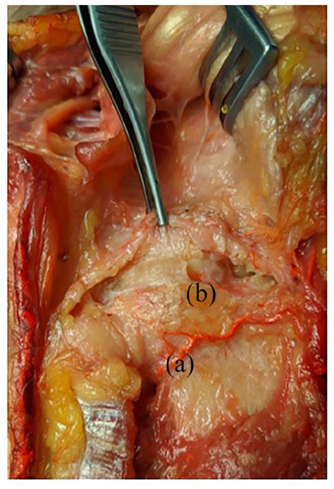 Avascular Necrosis Of The Lunate Secondary To Perilunate Fracture Dislocation Case Report And