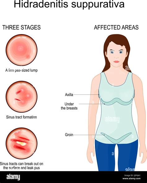 Faqs Zu Acne Inversa Hidradenitis Suppurativa Xaqe