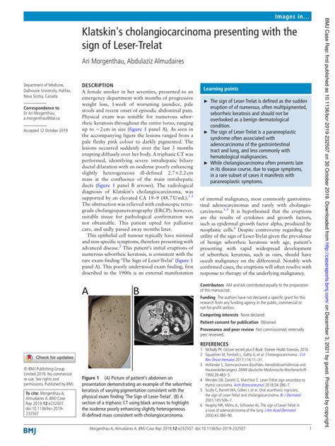 Pdf Klatskins Cholangiocarcinoma Presenting With The Sign Of Leser Trelat