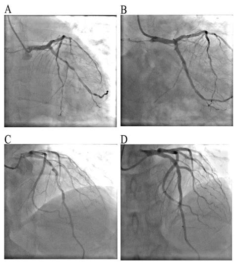 Left Circumflex Branch Long Lesion Stenosis 50 80 A Left