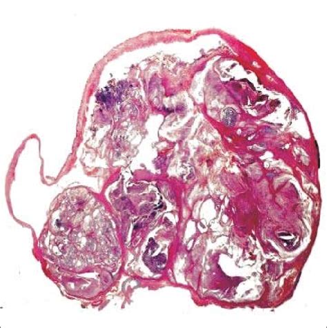 Figure 3 From A Challenging Delivery By Exit Procedure Of A Fetus With A Giant Cervical Teratoma