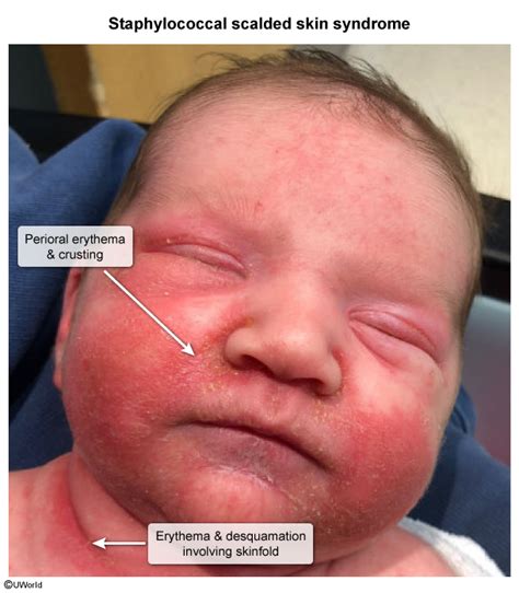 Staphylococcal Scalded Skin Syndrome Dermatology Uworld Medical Library