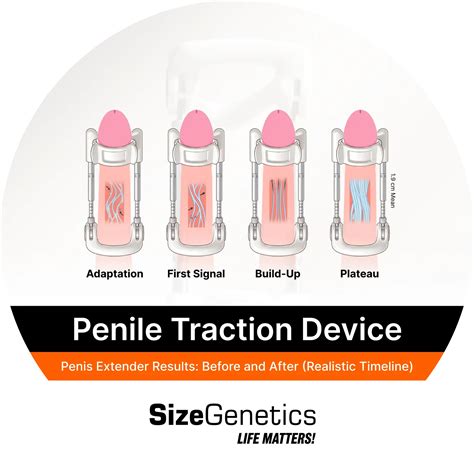 Penis Extender Results Before And After Realistic Timeline