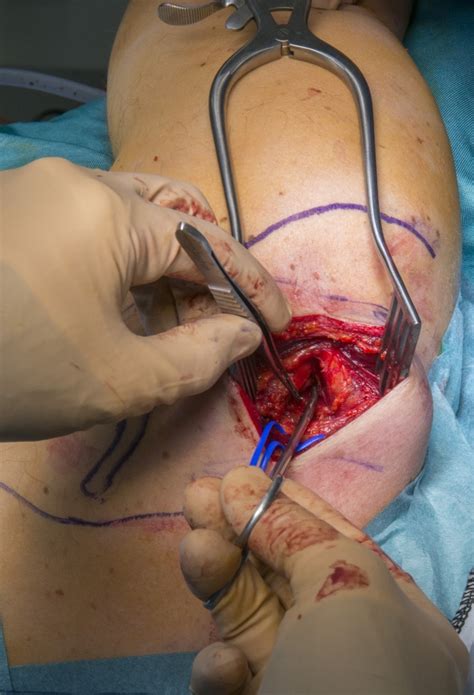 Suprascapular Nerve Decompression And Reconstruction Surgical Technique