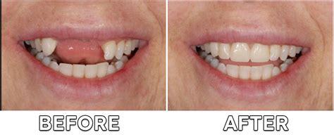 Lovilds™ Silicone Reline Denture Set Lovilds