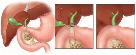 Operative Palliation Of Pancreatic Cancer Abdominal Key