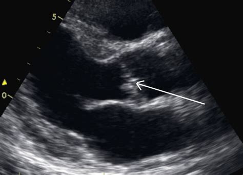 Transthoracic Echocardiogram Showing A Small Vegetation On Aortic Valve