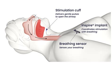 Inspire® Therapy For Obstructive Sleep Apnea North Alabama Ent Associates
