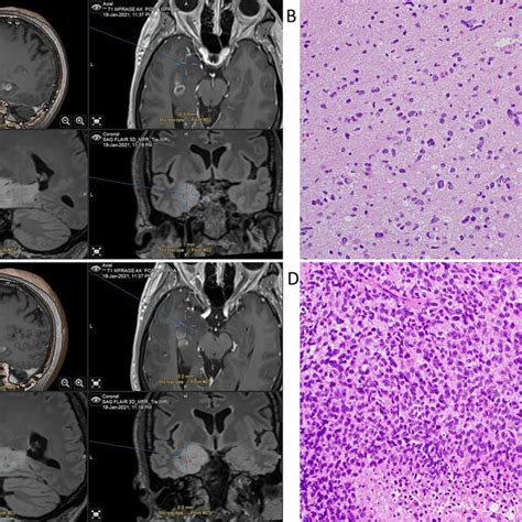 A Stereotactic Localization Of Region Of Tissue That Is On The