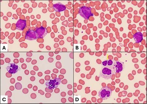 Acute Promyelocytic Leukemia With A Rare Tbl1xr1 Rara Fusion And
