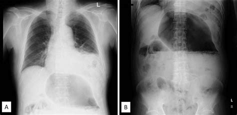 A Chest X Ray Shows An Abnormal Mass And Bowel Gas Shadow In The Left