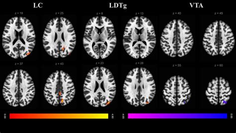 axial views of differences in voxelwise functional connectivity between