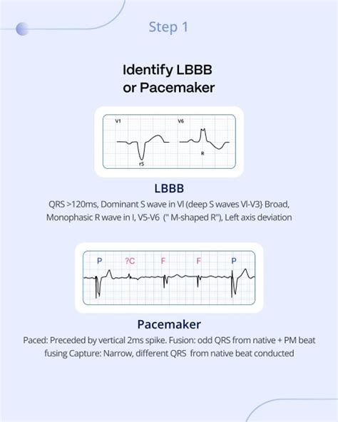 Sgarbossa Criteria Advanced Cardiac Diagnosis Pmcardio