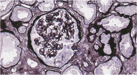 Membrana Basal Glomerular