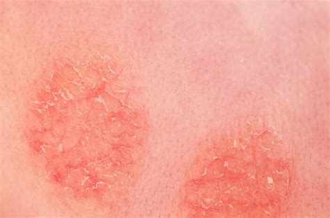 Faktor Yang Meningkatkan Risiko Terkena Dermatitis Numularis