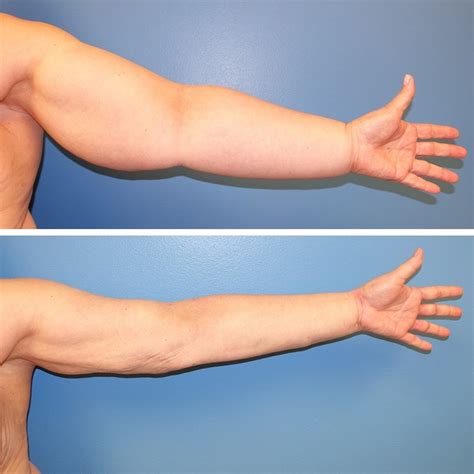 Body Wall Edema What Is Anasarca Causes Symptoms And Treatment