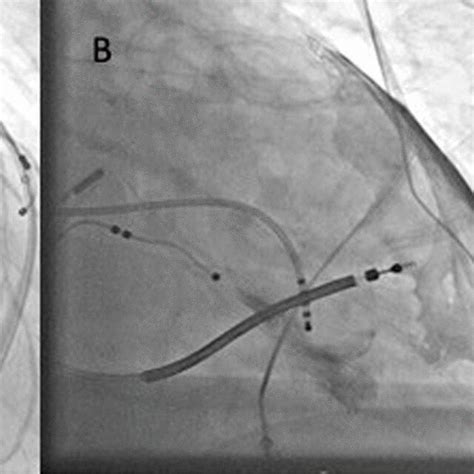 Two Predominant Scar Patterns Visualized With Lge On Cmr Scar Outlined Download Scientific