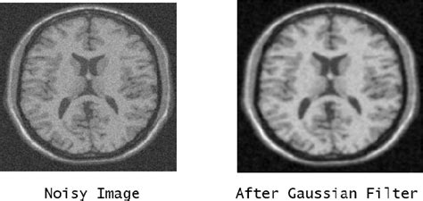 Figure 4 From Detection And Classification Of Brain Tumors Using Deep