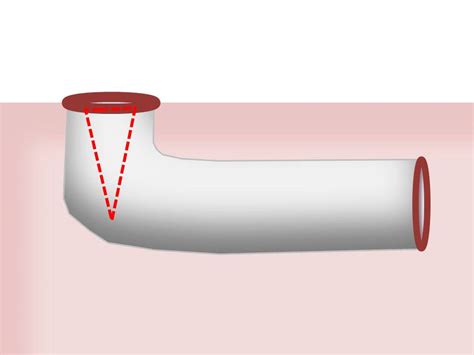 Punctoplasty Jonathan Norris