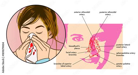 Vector Medical Illustration Of The Symptoms Of Epistaxis Nosebleed Stock Vector Adobe Stock