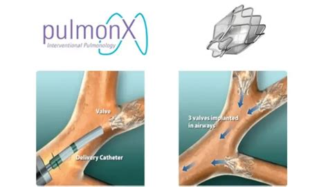 Endobronchial Valve Therapy Compass Medical
