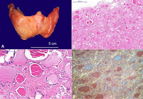 A Gross Examination Of The Thyroid Diffuse Enlargement Of The Gland