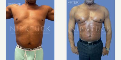Lipo 360 Before And After Pictures Realself