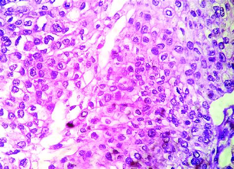 Polygonal Cells With Pleomorphic Vesicular Nucleus Moderate Clear To