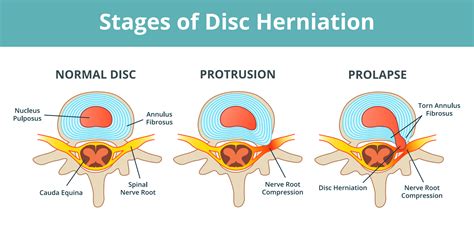 Effective Disc Bulge Treatment Ripple Chiropractic