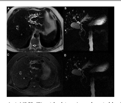 Figure 2 From Relapsing Polychondritis Following Primary Sclerosing