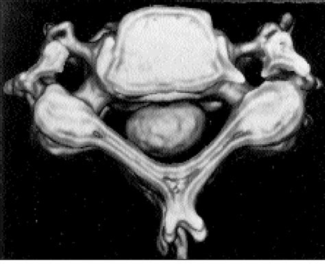 Computerized Tomography Reconstruction Scan Showing The Calcified Download Scientific Diagram