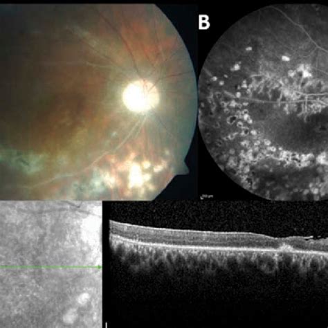 Late Phase Fluorescein Angiography Of The Right Eye Of A Patient With