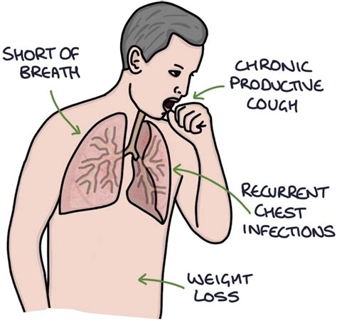 Bronchiectasis Zero To Finals