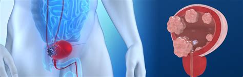 Malignant Tumor Of The Bladder Bladder Cancer Comprehensive Guide To