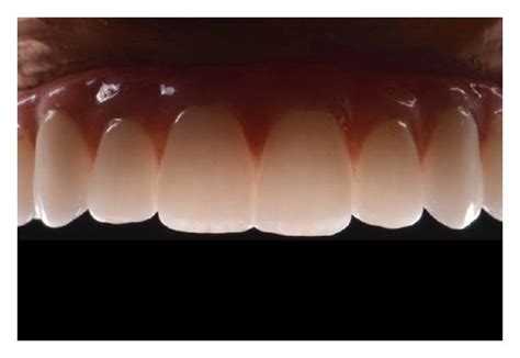 Translucency Effect In The Anterior Maxilla After Application Of
