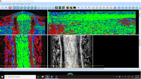 What Is Ultrasound Tissue Characterization An Introductory Overview