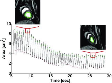 LV Area Plot Calculated By The Level Set Algorithm With Representative Download Scientific