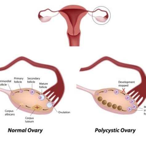 Confused About What Causes Pcos Pcos Tests