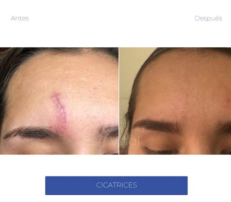 Tratamiento Para Cicatrices Con Láser Esvital Center