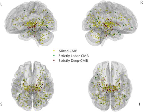 Topographical Distributions Of Cerebral Microbleeds Cmb In