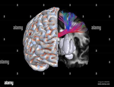 Corpus Callosum DTI MRI Scan Stock Photo Alamy