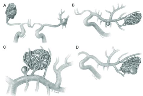 Classification Of Avm Associated With Aneurysm Showing Unrelated