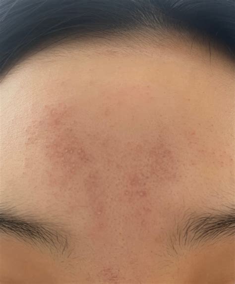 제모크림 피부 발진 지식in