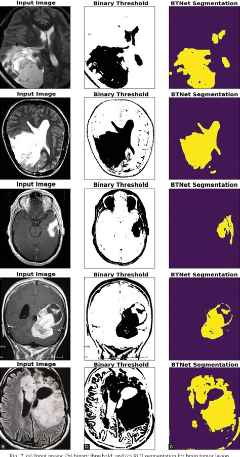 Figure 1 From Brain Tumor Segmentation Using Enhancement Convolved And