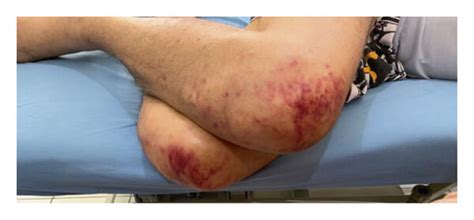 Large Ecchymosis In The Lower Extremities Download Scientific Diagram